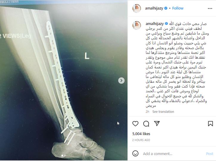 امل حجازي تتعرض لإصابة وكسور في الرجلين والظهر وتطلب الدعاء Jadeedoha